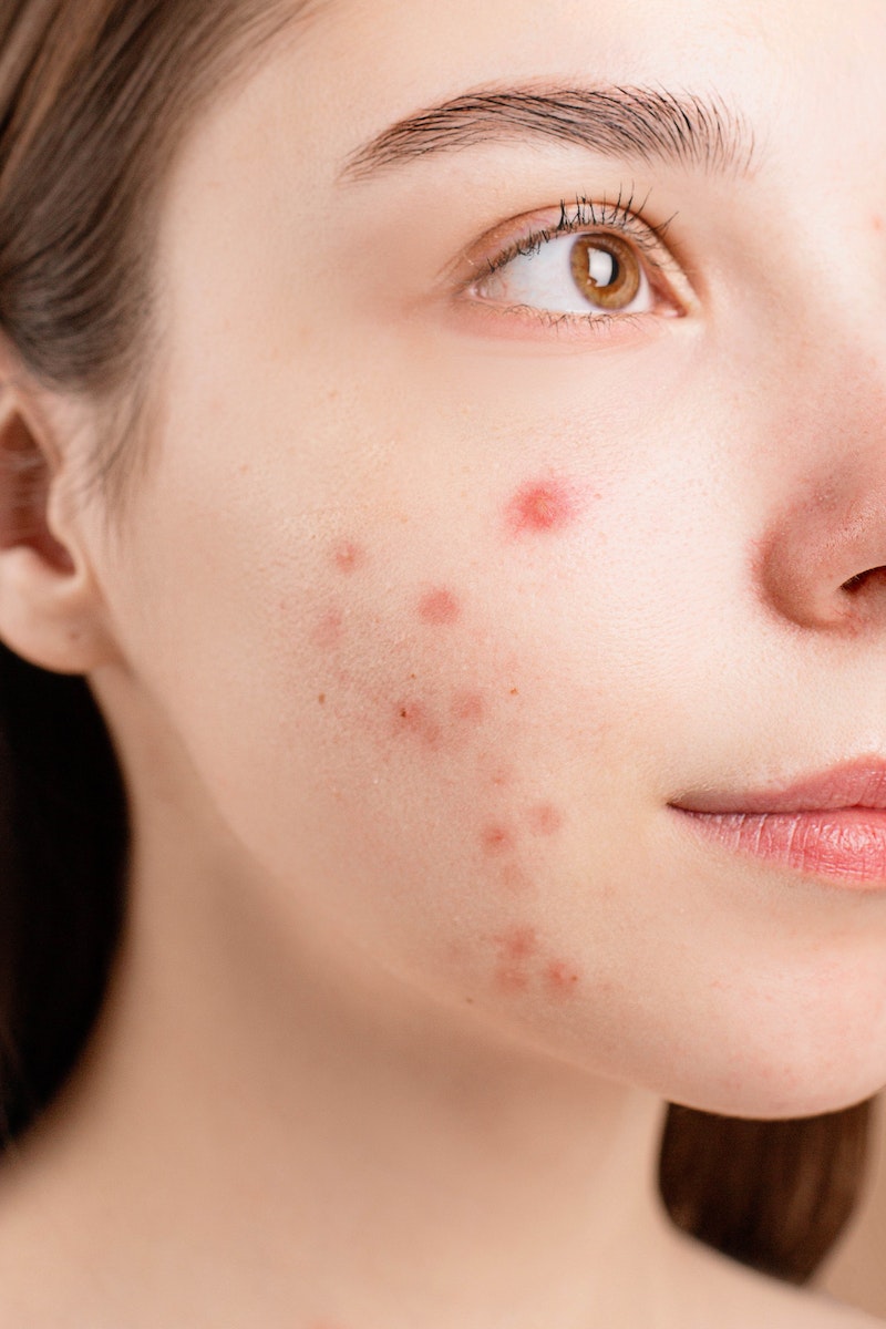 Accutane For Acne: How Effective Is It? - Dietitian Glasgow
